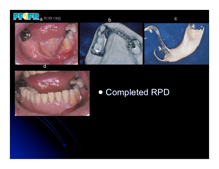 24.(new)mfp defects and rpd design