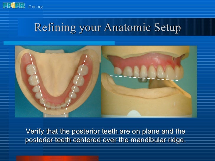 24.refine denture setup