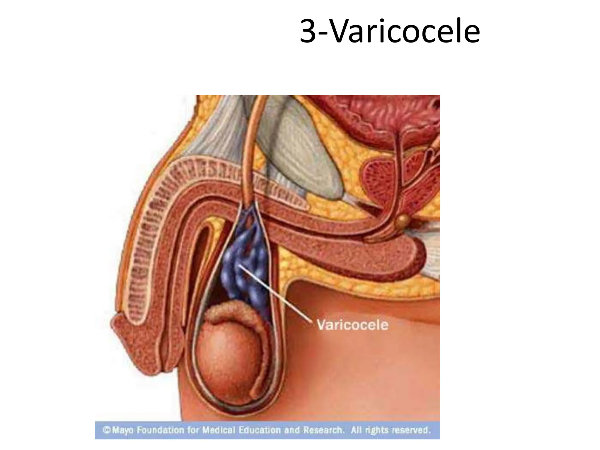 Scrotal Swelling And Differential Diagnosis Ppt