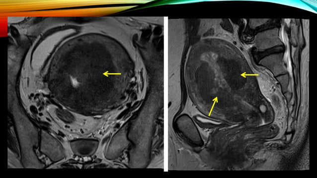 24082024 FIGO FOGSI HYD ENDOMETRIAL CANCER – EARLY DIAGNOSIS AND ...