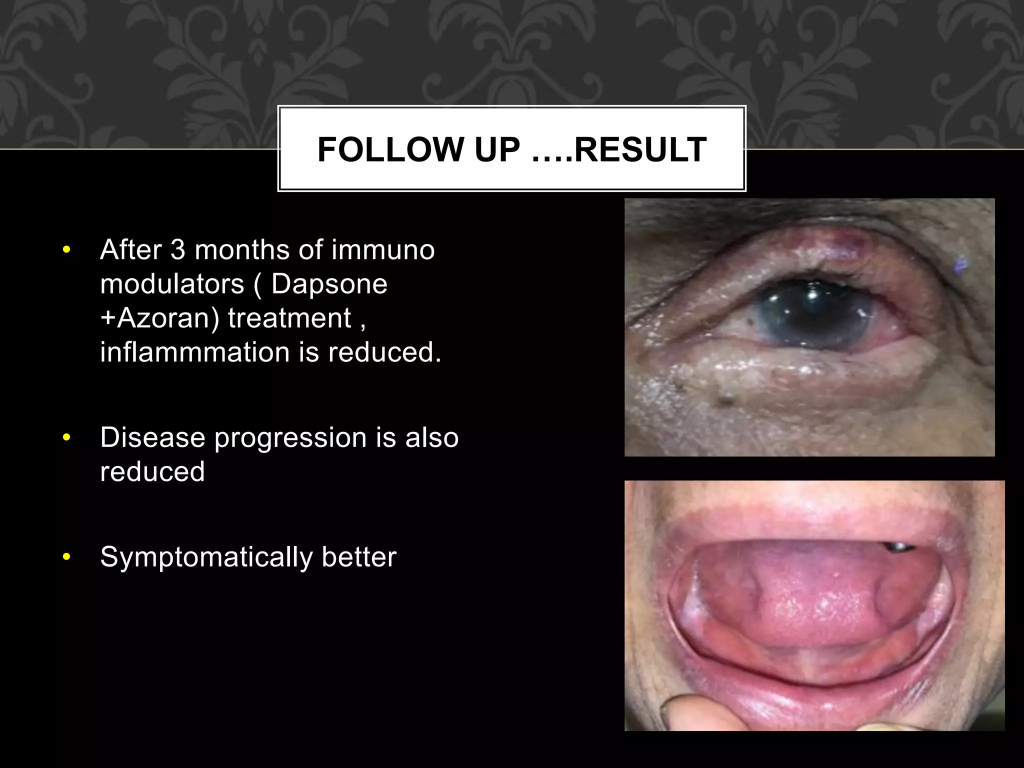 Late Ocular Presentation In A Case Of Cicatricial Pemphigoid | PPTX