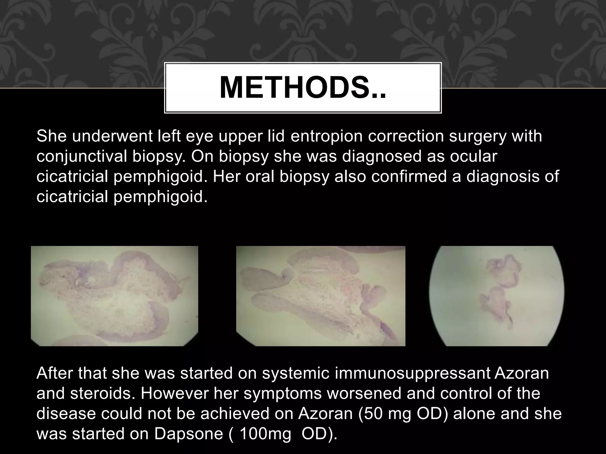 Late Ocular Presentation In A Case Of Cicatricial Pemphigoid | PPTX