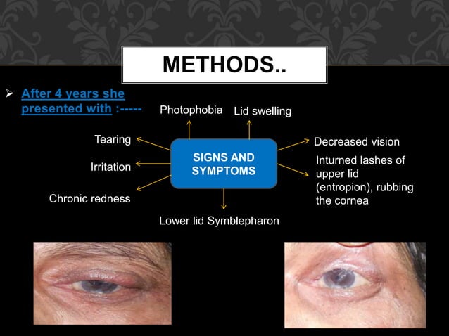 Late Ocular Presentation In A Case Of Cicatricial Pemphigoid | PPTX ...