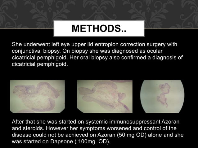 Late Ocular Presentation In A Case Of Cicatricial Pemphigoid | PPTX ...