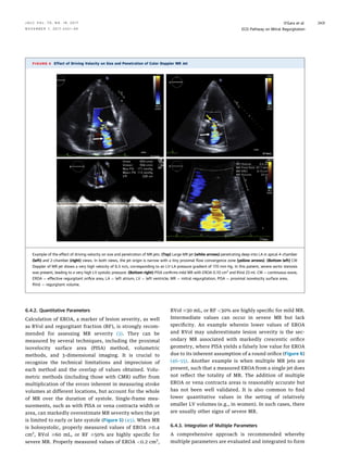 management Mitral valve Regurgitaion | PDF
