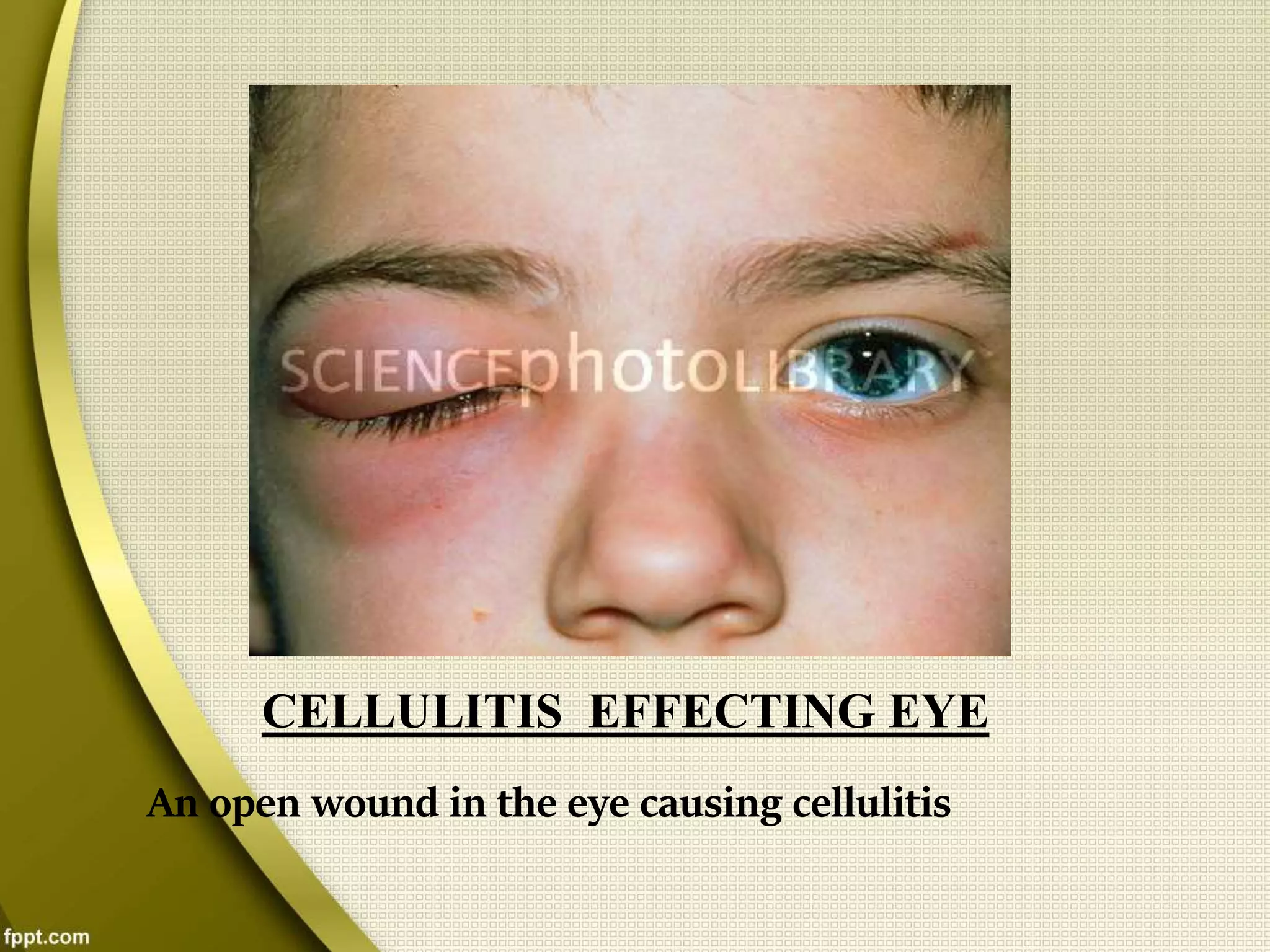 case study on cellulitis | PPT