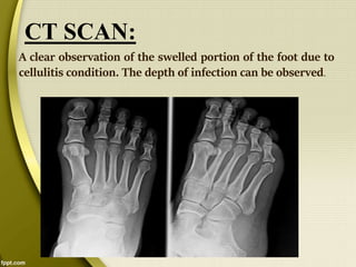 case study on cellulitis | PPT