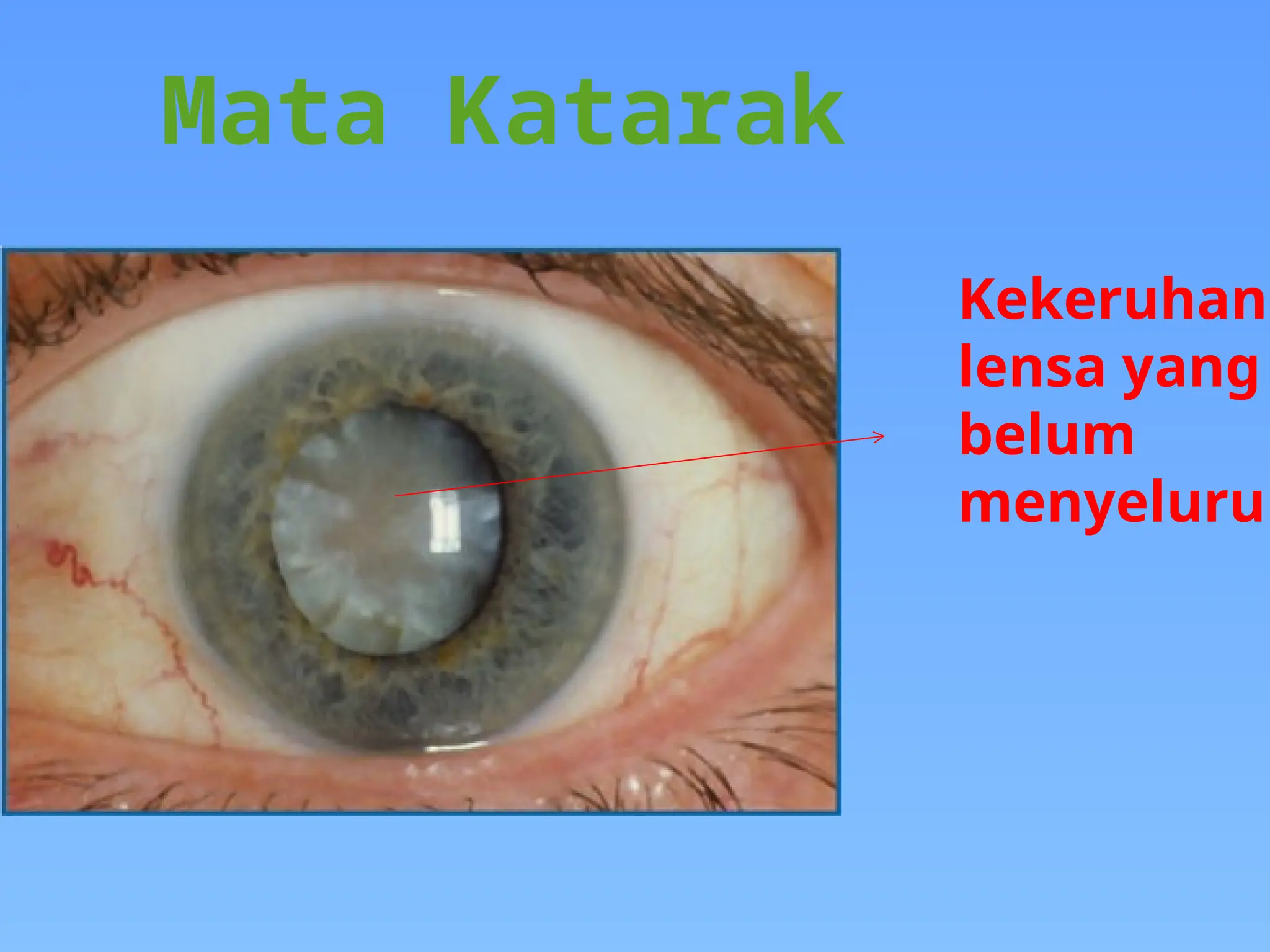 mengenali katarak beserta cara pencegahannya | PPTX