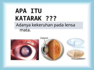 mengenali katarak beserta cara pencegahannya | PPTX