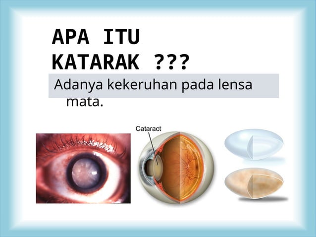 mengenali katarak beserta cara pencegahannya | PPTX