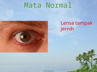 mengenali katarak beserta cara pencegahannya | PPTX