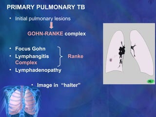 Pulmonary Tuberculosis - Radiological Images | PPT