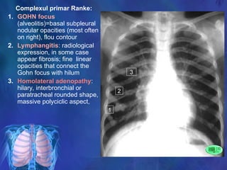 Pulmonary Tuberculosis - Radiological Images | PPT