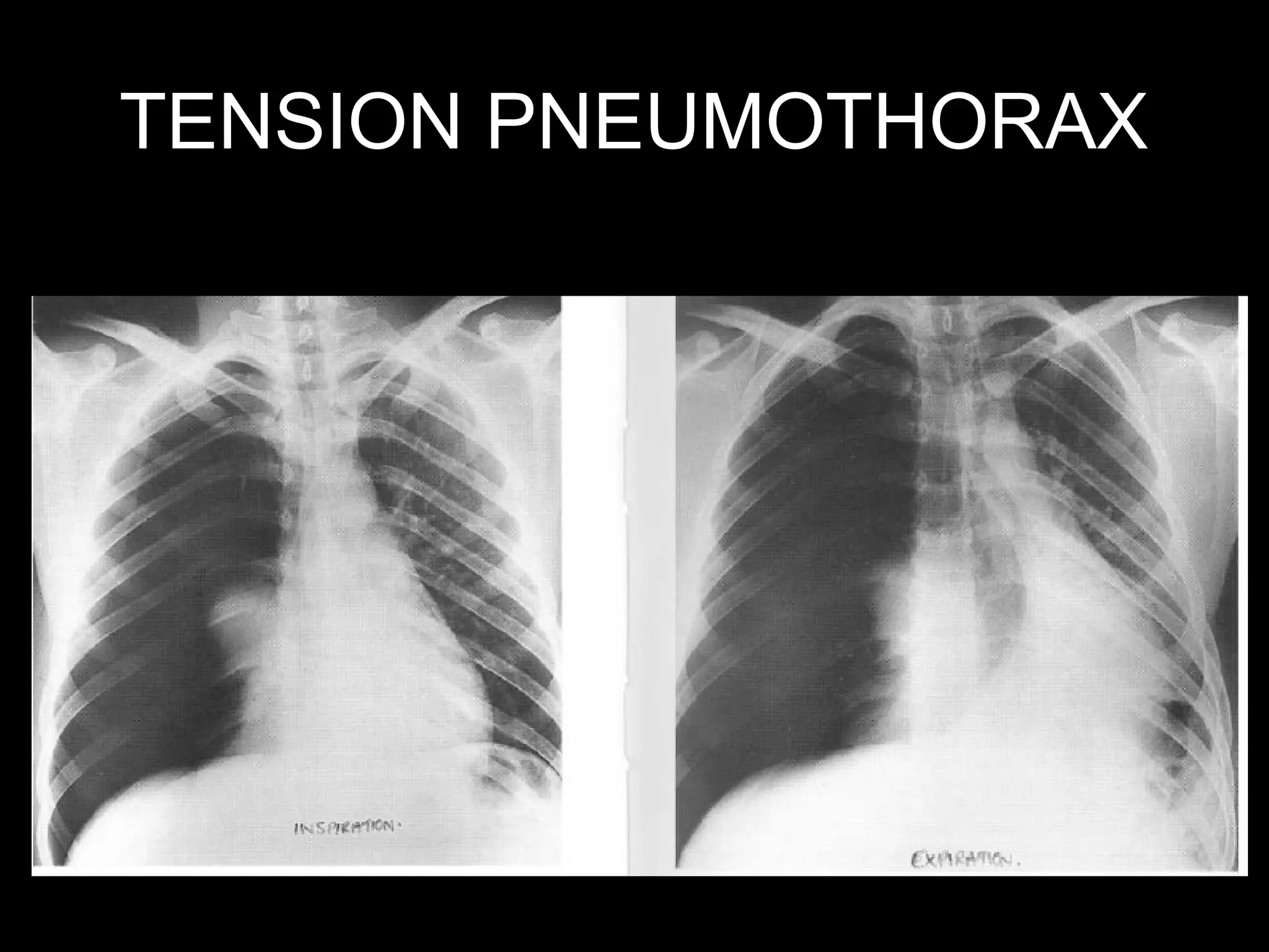 243221265-129577767-Cara-Mudah-Membaca-Rontgen-Thorax-ppt.ppt