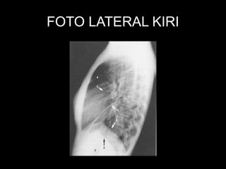 243221265-129577767-Cara-Mudah-Membaca-Rontgen-Thorax-ppt.ppt