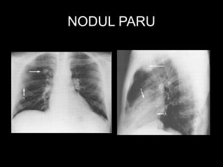 243221265-129577767-Cara-Mudah-Membaca-Rontgen-Thorax-ppt.ppt