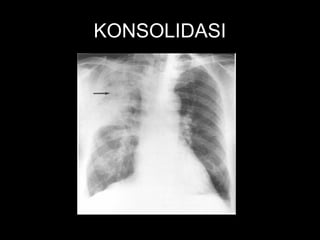 243221265-129577767-Cara-Mudah-Membaca-Rontgen-Thorax-ppt.ppt