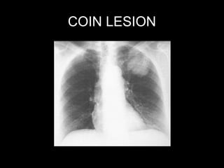 243221265-129577767-Cara-Mudah-Membaca-Rontgen-Thorax-ppt.ppt