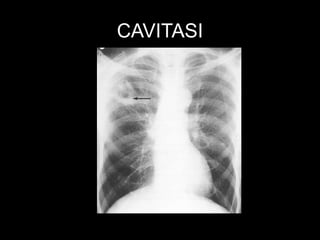 243221265-129577767-Cara-Mudah-Membaca-Rontgen-Thorax-ppt.ppt