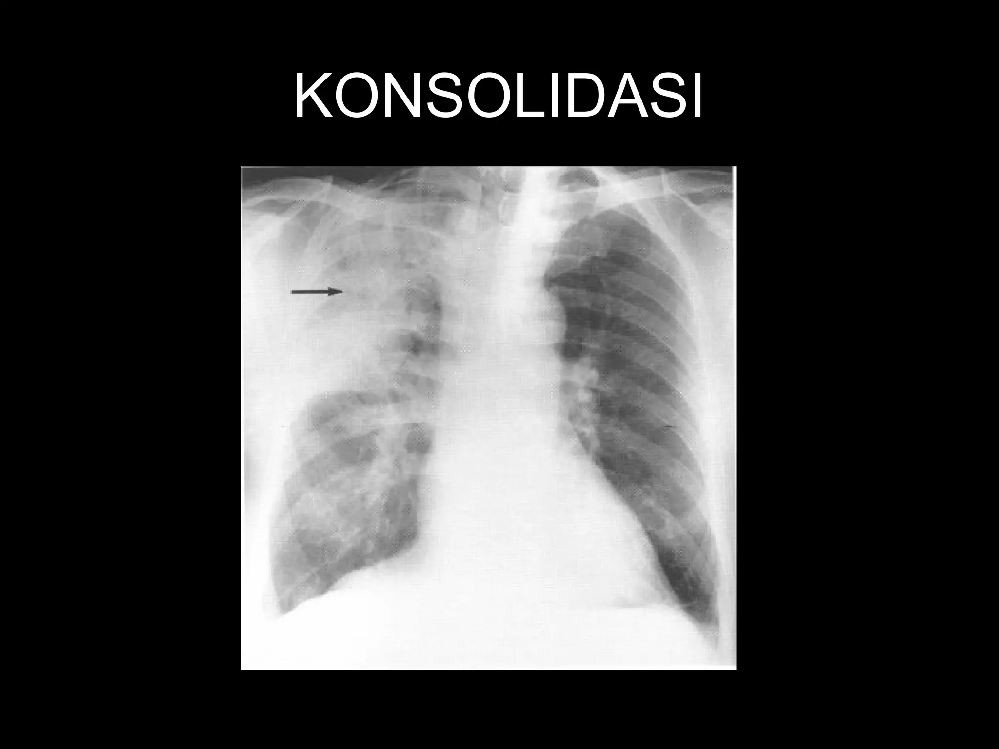 243221265-129577767-Cara-Mudah-Membaca-Rontgen-Thorax-ppt.ppt