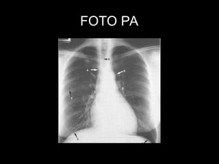 243221265-129577767-Cara-Mudah-Membaca-Rontgen-Thorax-ppt.ppt