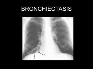 243221265-129577767-Cara-Mudah-Membaca-Rontgen-Thorax-ppt.ppt