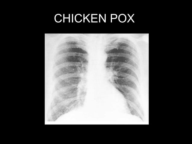 243221265-129577767-Cara-Mudah-Membaca-Rontgen-Thorax-ppt.ppt