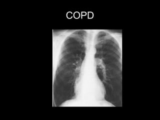 243221265-129577767-Cara-Mudah-Membaca-Rontgen-Thorax-ppt.ppt