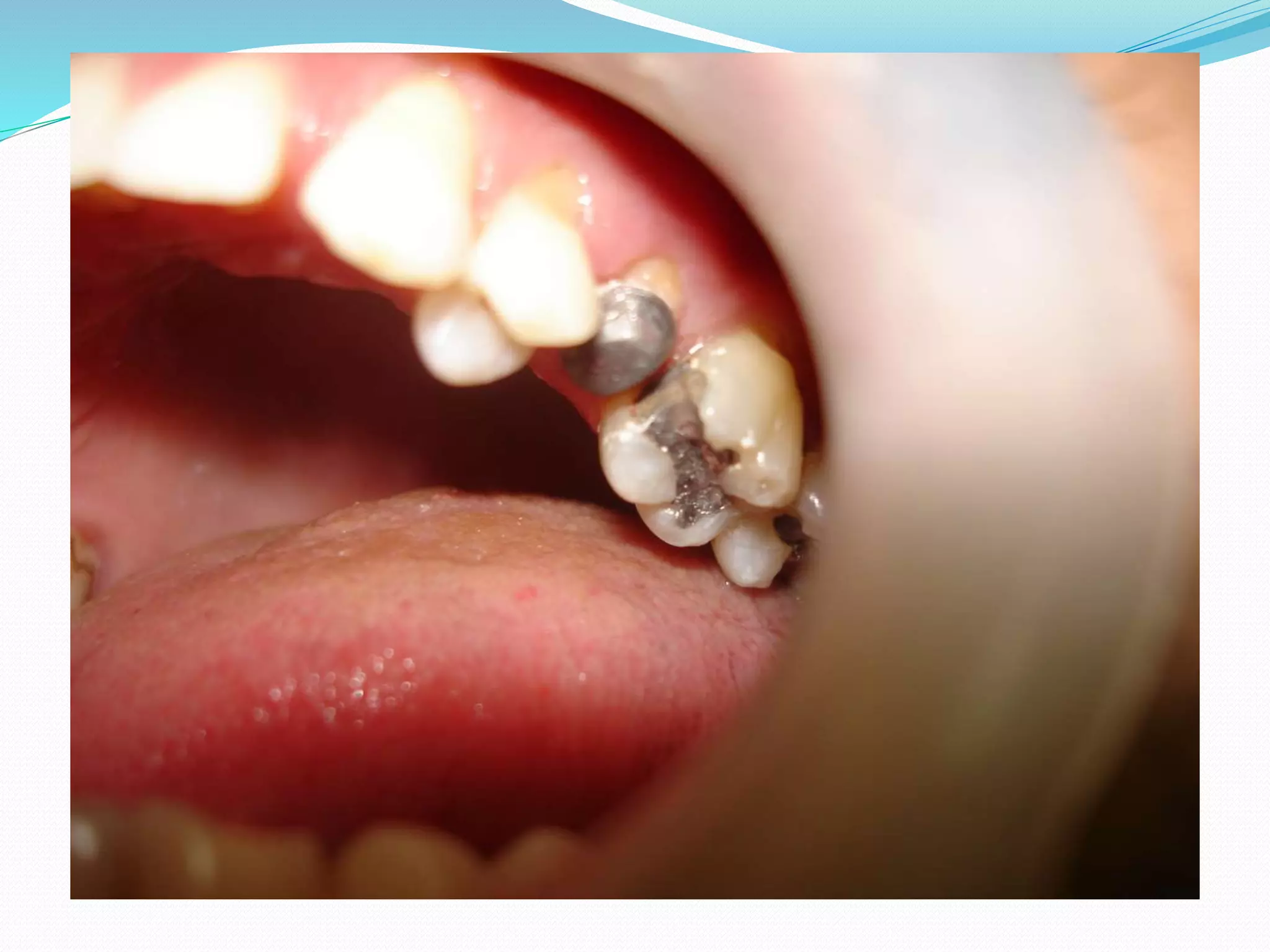 Post core – Pre molar Tooth | PPTX