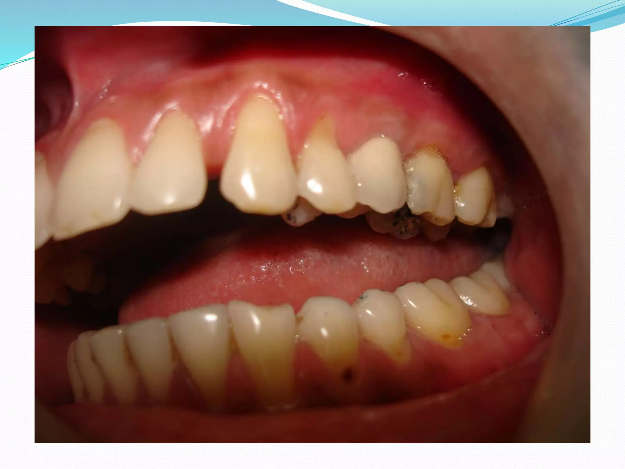 Post core – Pre molar Tooth | PPTX