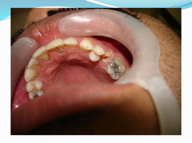 Post core – Pre molar Tooth | PPTX
