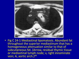 24 anterior mediastinal lesions on computed tomography | PPTX