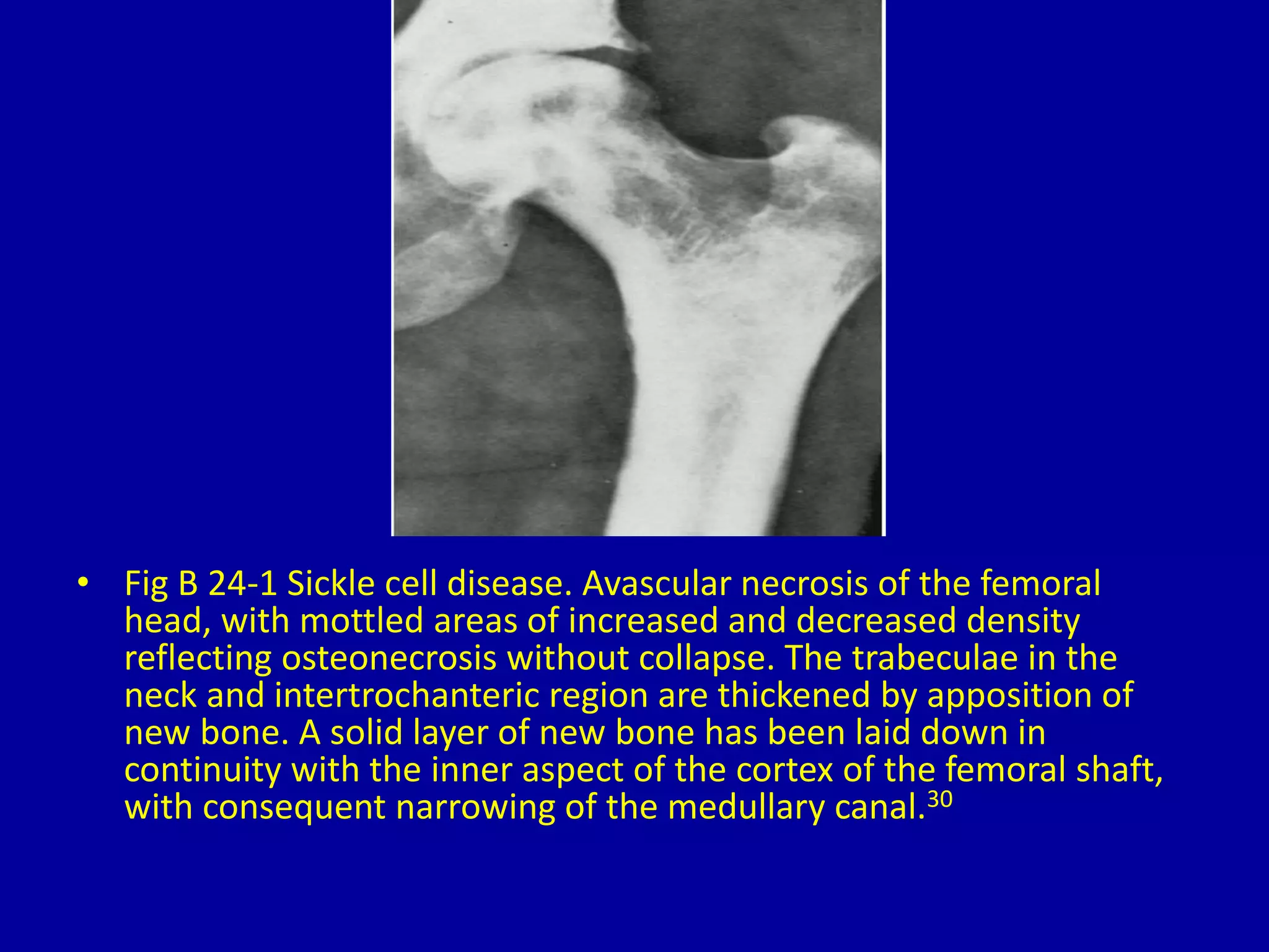 24 avascular necrosis of the hip or other | PPTX