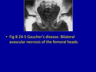 24 avascular necrosis of the hip or other | PPTX