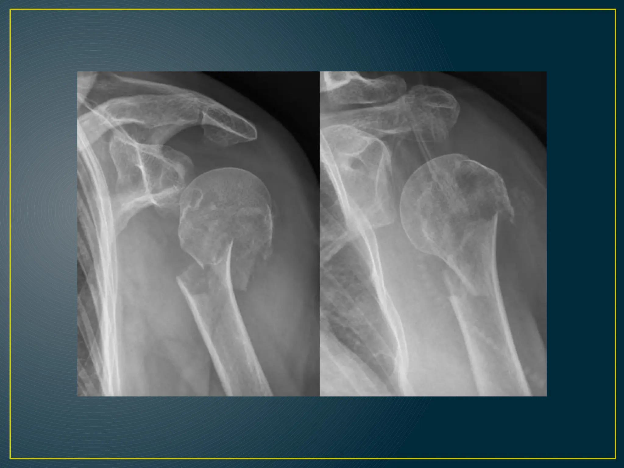 24 CLAVICLE FRACTURES + prox humerus.pptx