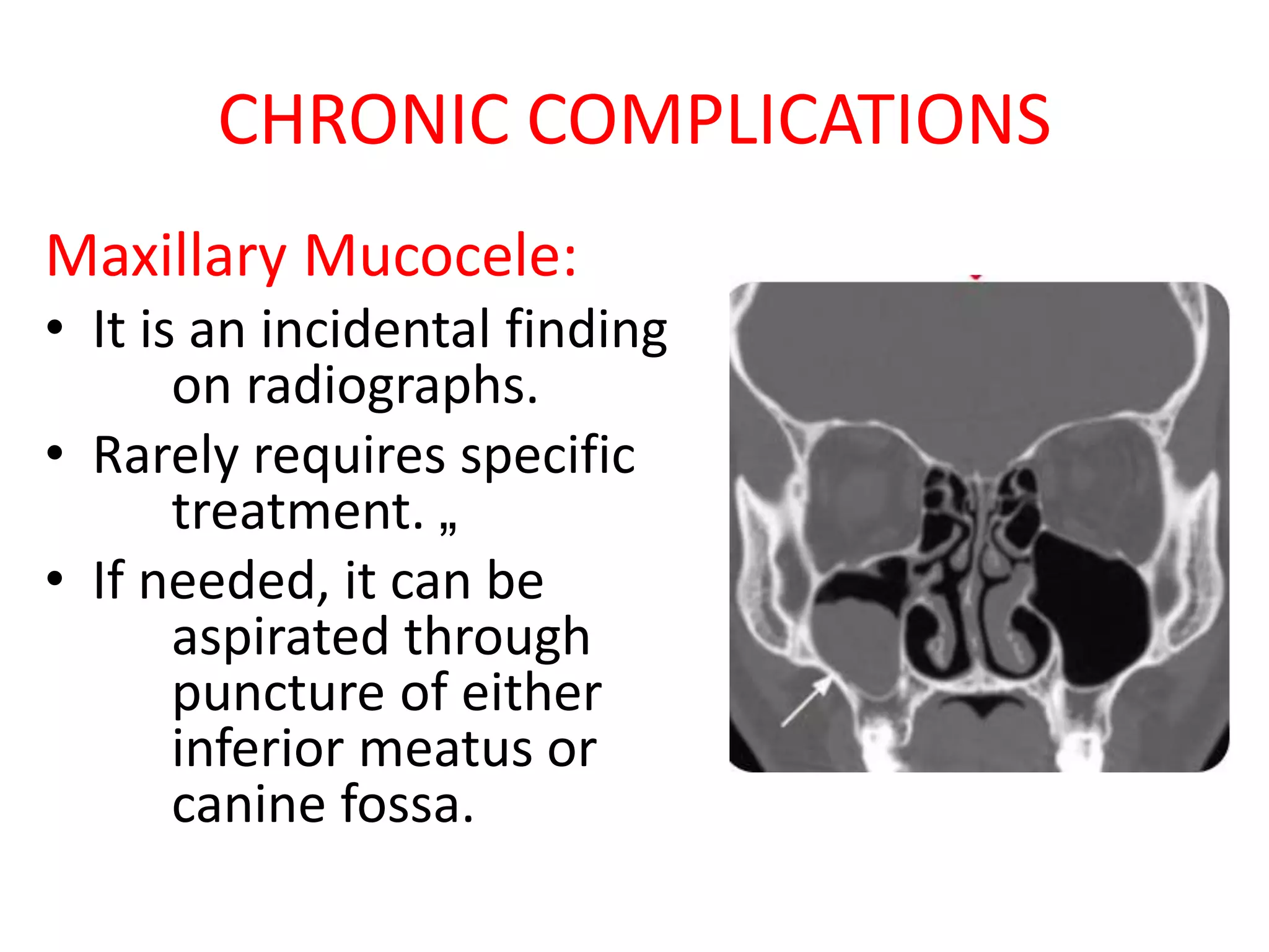 Complications of Sinusitis | PPTX
