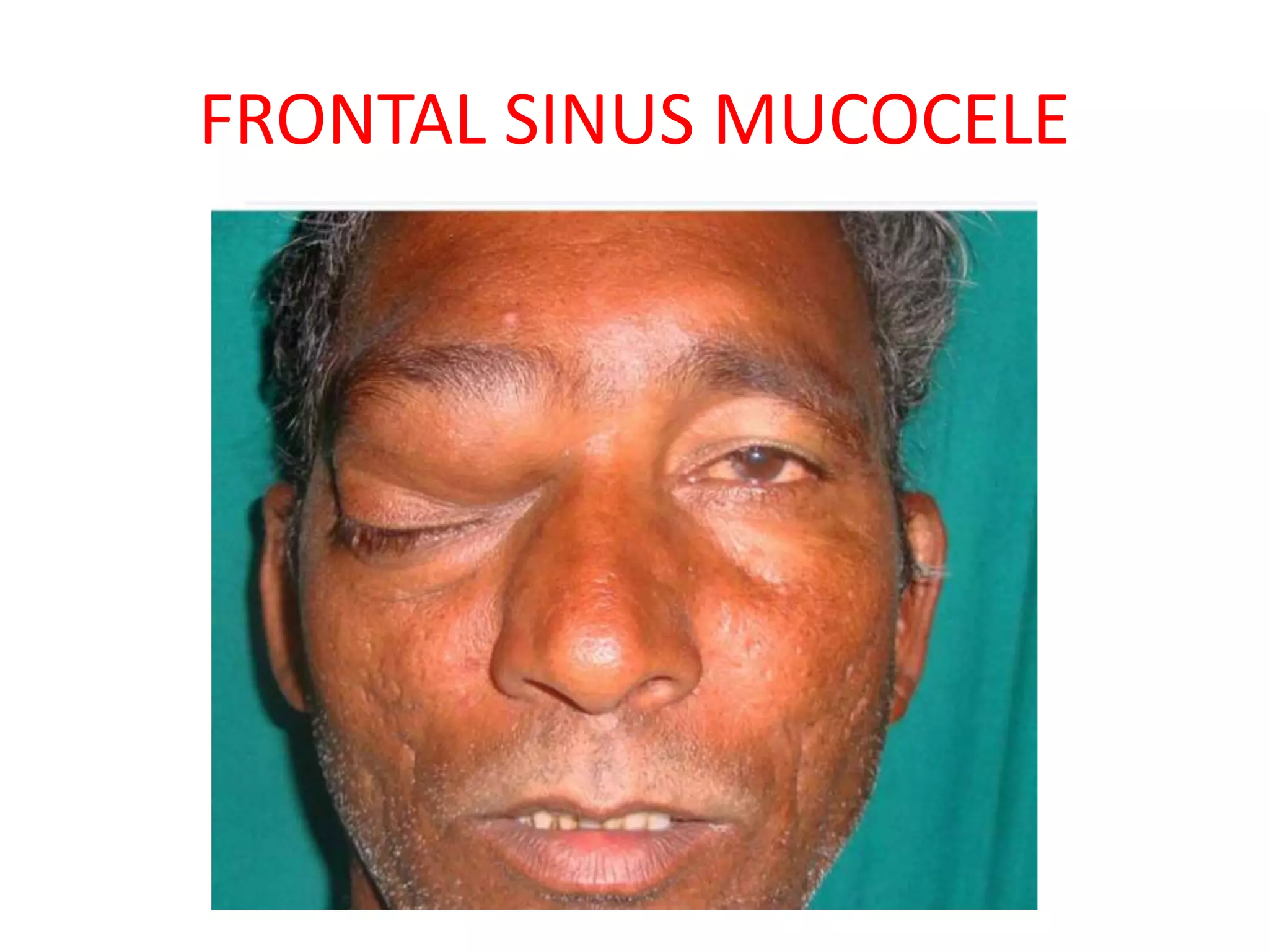 Complications of Sinusitis | PPTX