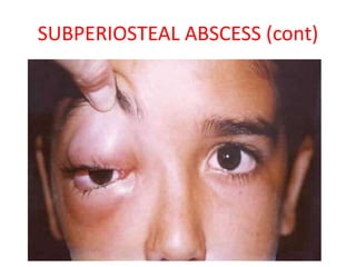 Complications of Sinusitis | PPTX