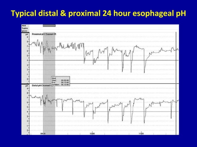 pH monitoring of the esophagus | PPTX