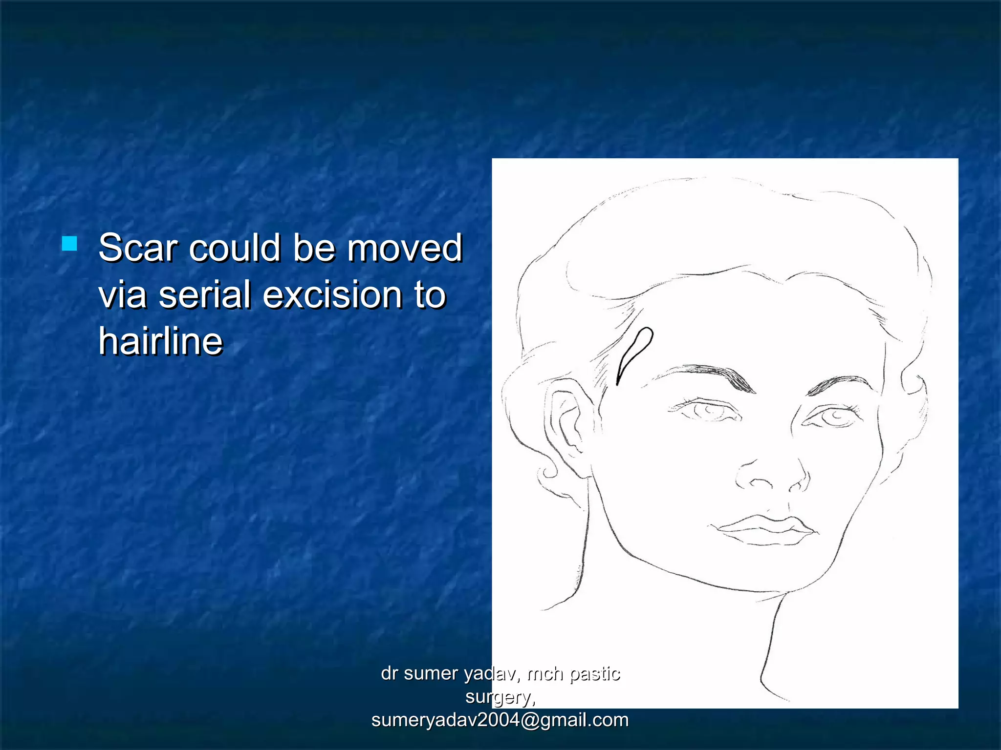 scar revision , z plasty | PPT | Skin and Dermatology | Diseases and ...