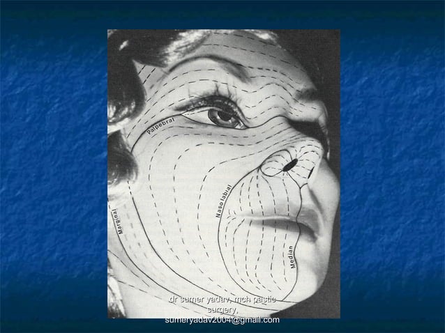 scar revision , z plasty | PPT | Skin and Dermatology | Diseases and ...