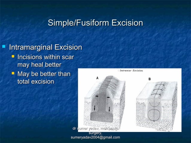 scar revision , z plasty | PPT | Skin and Dermatology | Diseases and ...