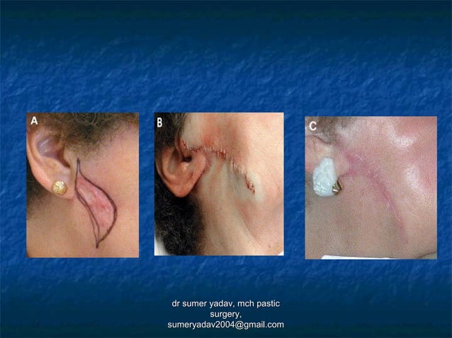scar revision , z plasty | PPT | Skin and Dermatology | Diseases and ...