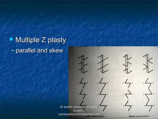 scar revision , z plasty | PPT