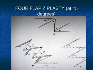 scar revision , z plasty | PPT