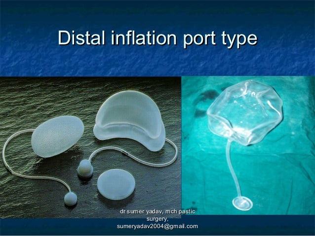 scar revision , z plasty