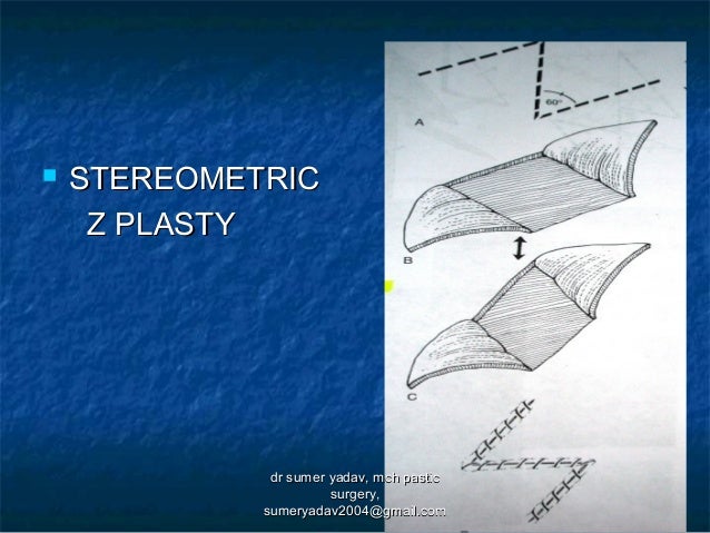 scar revision , z plasty