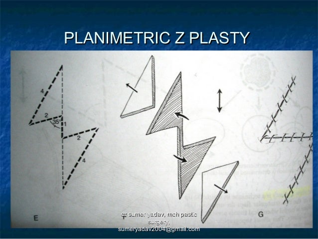 scar revision , z plasty
