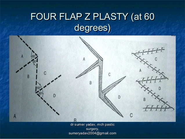 scar revision , z plasty