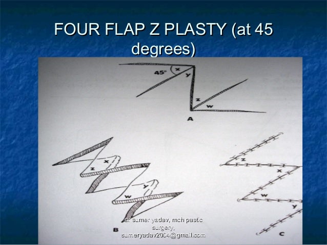 scar revision , z plasty
